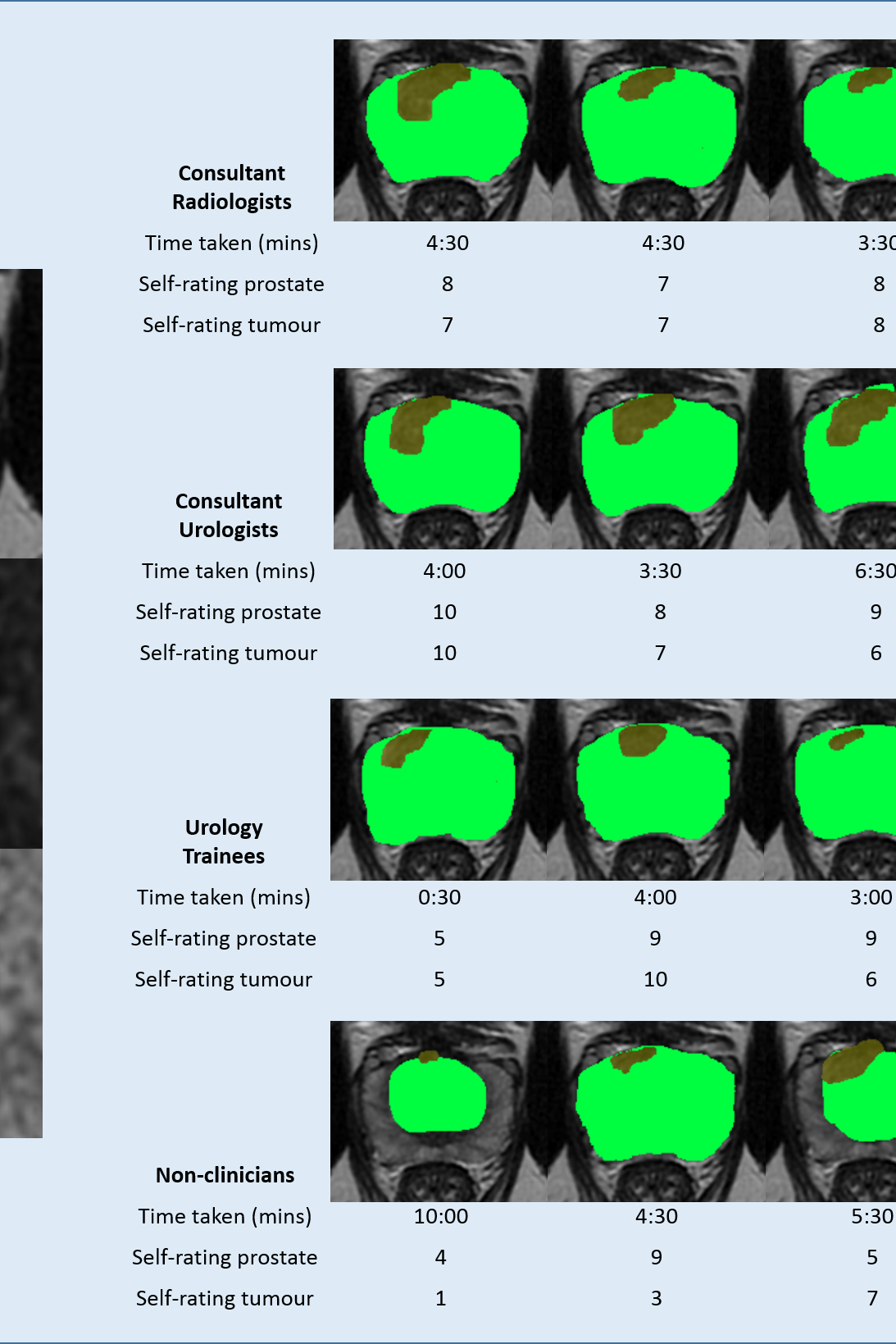 Variability In Accuracy Of Prostate Cancer Segmentation Among