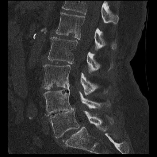 Osteoporotic Fractures & the Aging Spine - Biomechanics and Spine ...