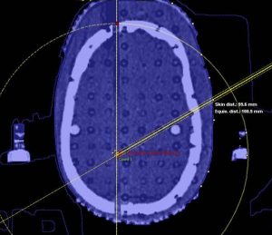Small Field Radiotherapy - Medical Physics