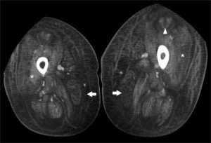 Estimation of intramuscular fat content using ultrasound advanced ...