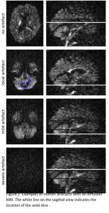 Improving quality of diffusion MRI: detection of motion artefacts ...