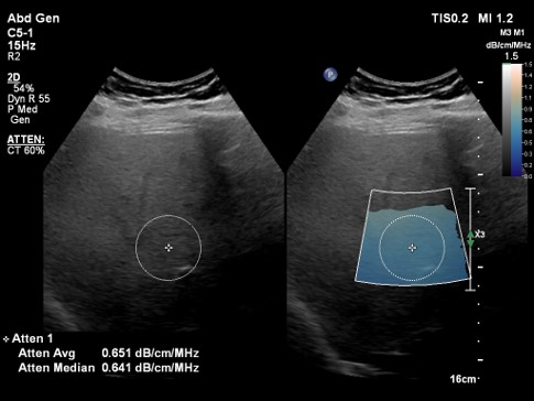 Optimising Ultrasound-based Liver Fat Quantification Methods - QUIQ ...