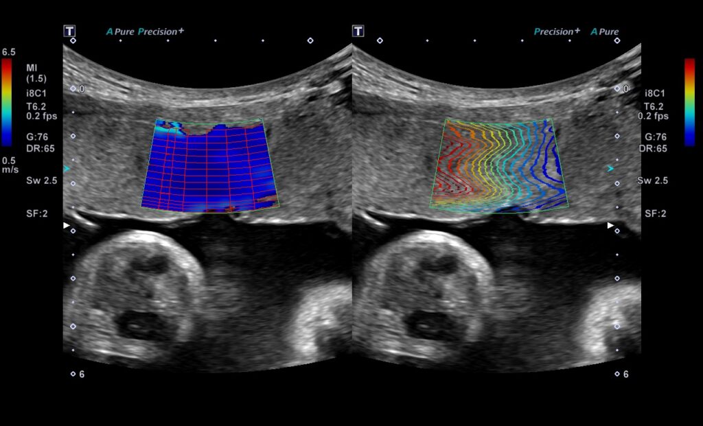 Shear Wave Elastography of Soft Tissues - QUIQ: Quantitative Ultrasound ...